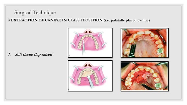 Canine impaction | PPTX