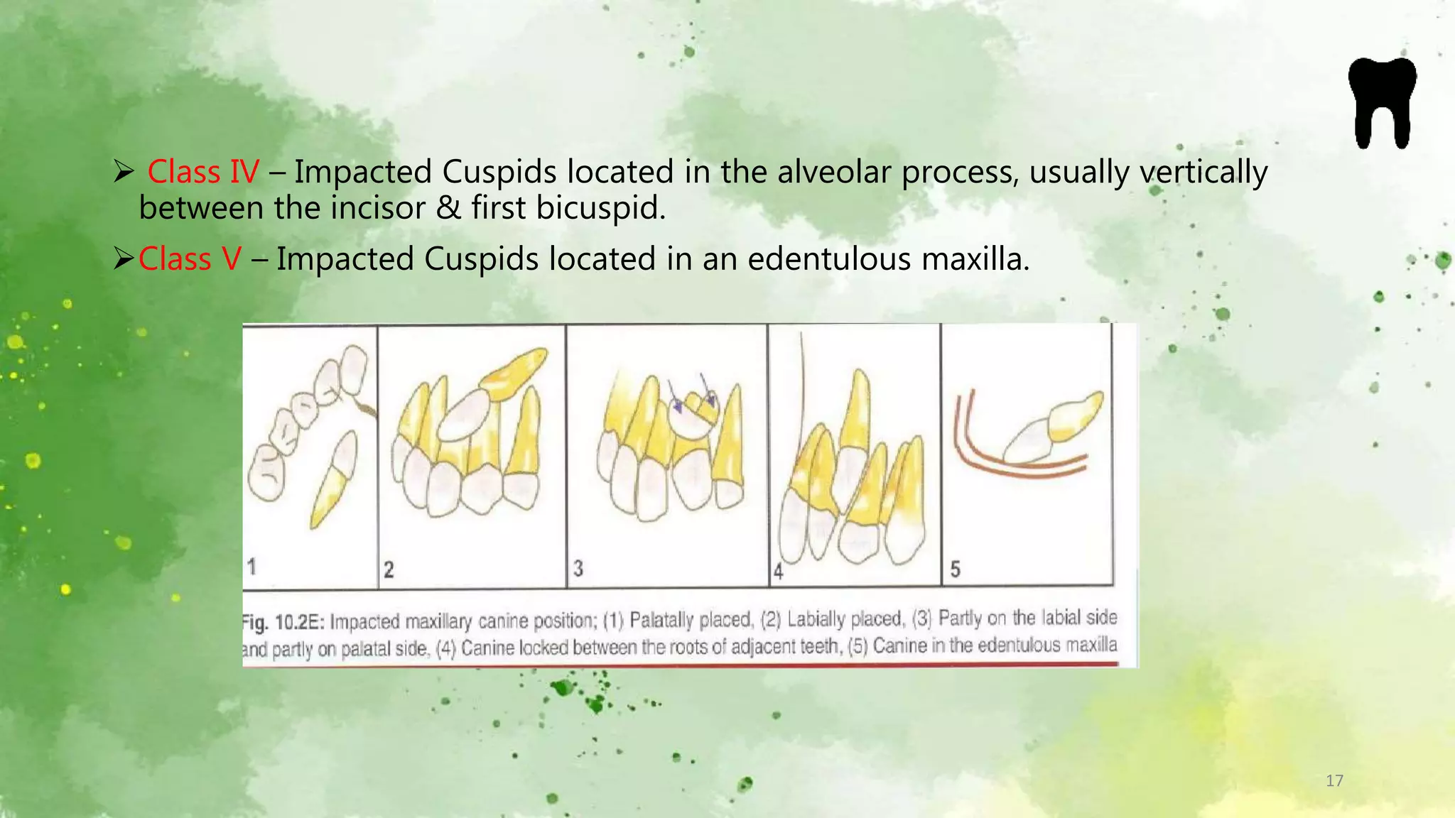 Canine impaction maxillary teeth part 2 | PPTX | Dental Health ...