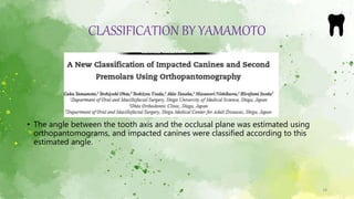 Canine impaction maxillary teeth part 2 | PPT