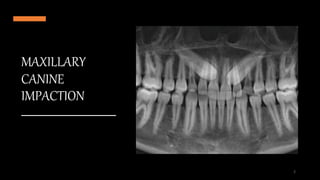 Canine impaction maxillary teeth part 2 | PPT