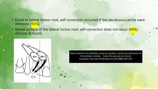 Canine impaction maxillary teeth part 2 | PPT
