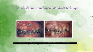 Canine impaction maxillary teeth part 2 | PPT