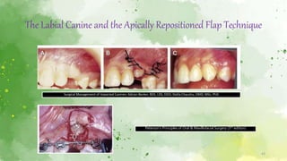 Canine impaction maxillary teeth part 2 | PPT