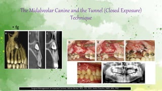 Canine impaction maxillary teeth part 2 | PPT