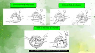 Canine impaction maxillary teeth part 2 | PPT