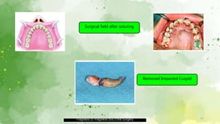 Canine impaction maxillary teeth part 2 | PPT