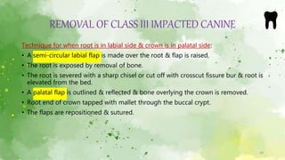 Canine impaction maxillary teeth part 2 | PPT