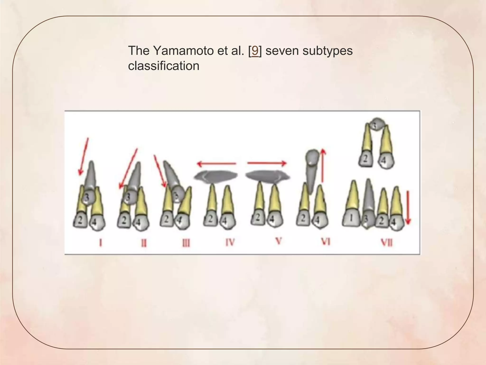 CANINE IMPACTION 1.pptx