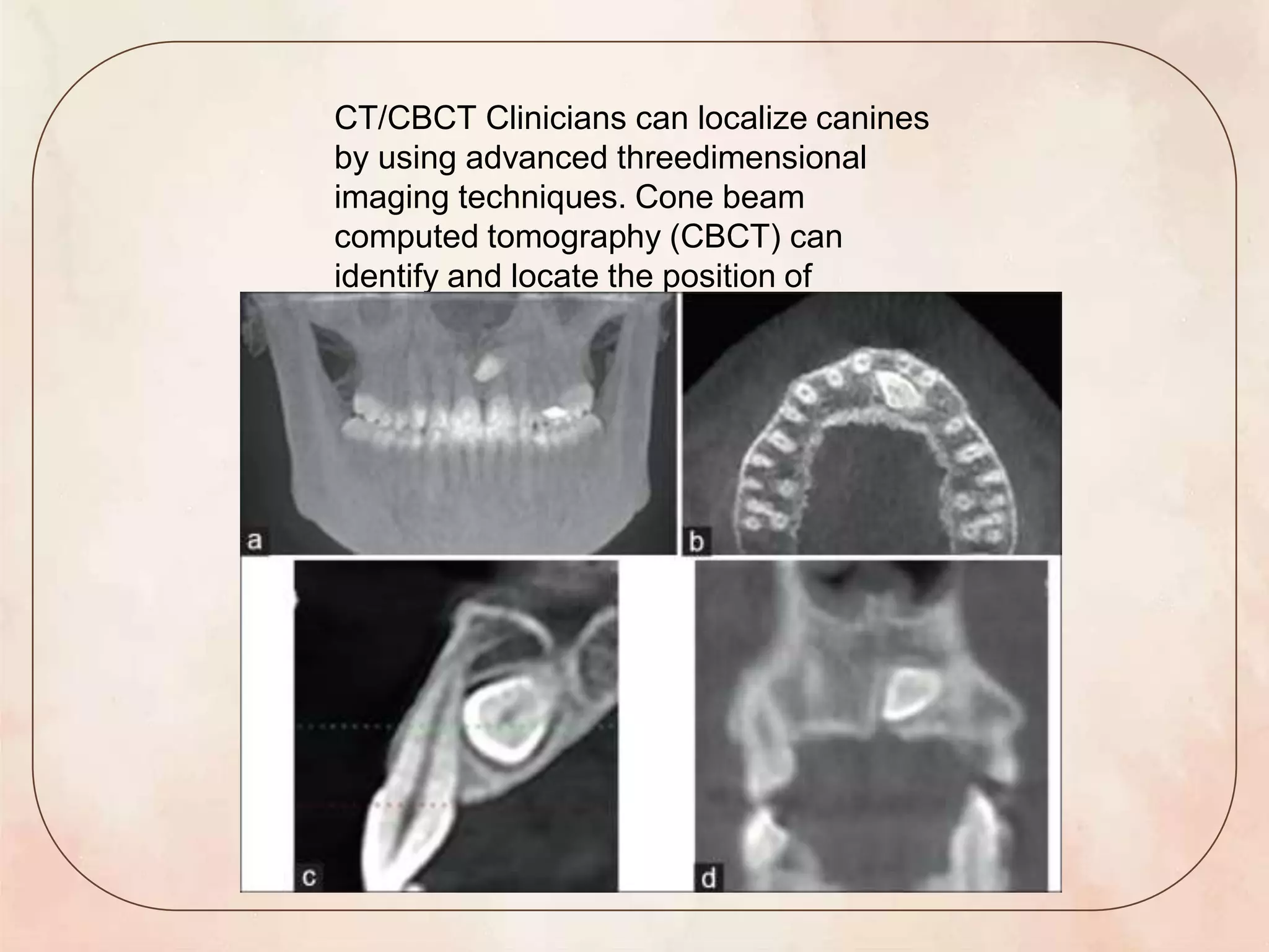 CANINE IMPACTION 1.pptx