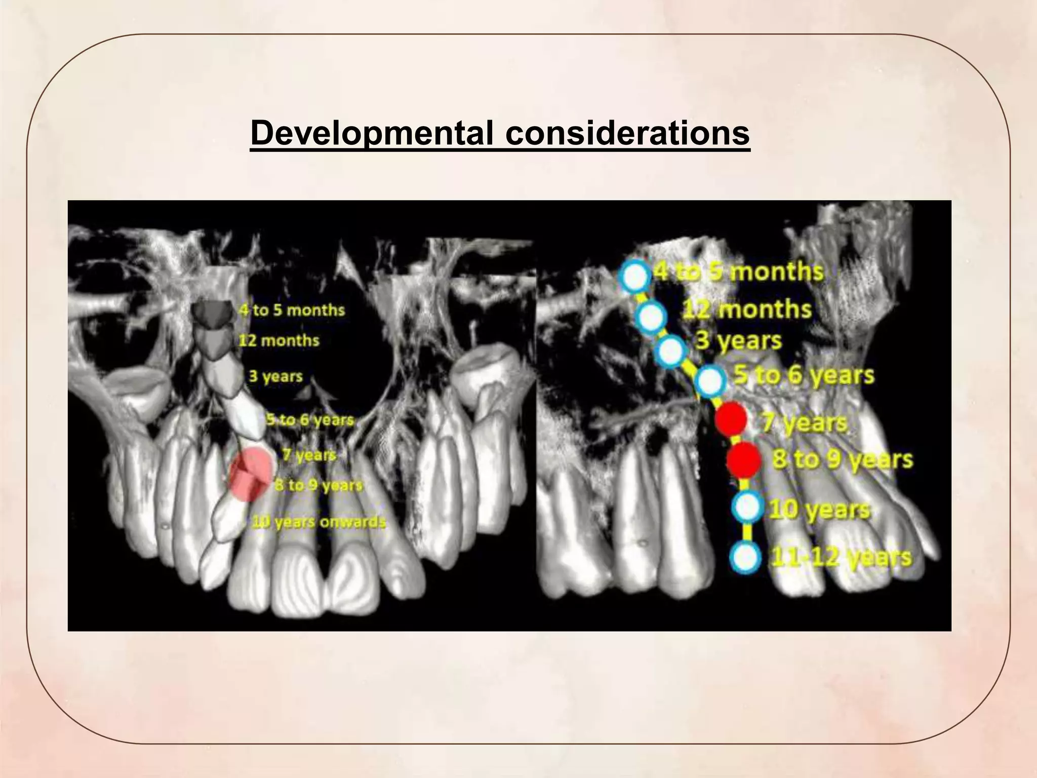 CANINE IMPACTION 1.pptx