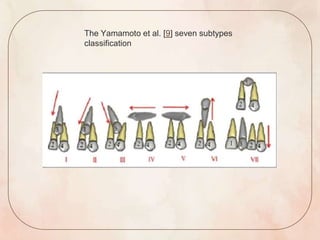 CANINE IMPACTION 1.pptx
