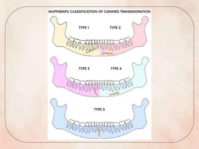 CANINE IMPACTION 1.pptx
