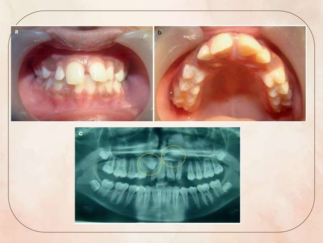 CANINE IMPACTION 1.pptx