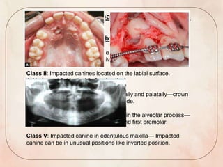 CANINE IMPACTION 1.pptx