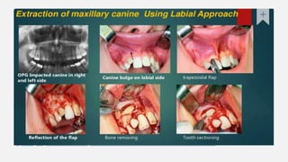 CANINE IMPACTION AND ITS CLINICAL CONSIDERATIONS.pptx