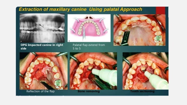 CANINE IMPACTION AND ITS CLINICAL CONSIDERATIONS.pptx | Dental Health ...