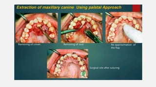 CANINE IMPACTION AND ITS CLINICAL CONSIDERATIONS.pptx