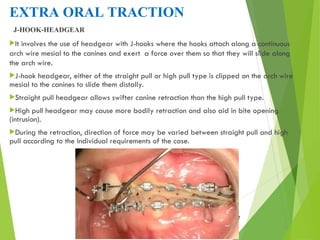 Comprehensive Overview of Canine Retraction in Orthodontics ...