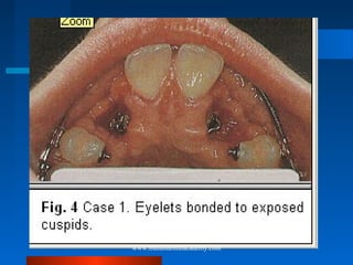 Canines treatment of palatally impacted cuspids with the extrusion | PPT