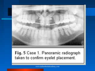 Canines treatment of palatally impacted cuspids with the extrusion | PPT