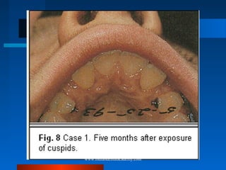 Canines treatment of palatally impacted cuspids with the extrusion | PPT