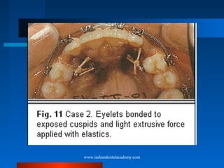 Canines treatment of palatally impacted cuspids with the extrusion | PPT