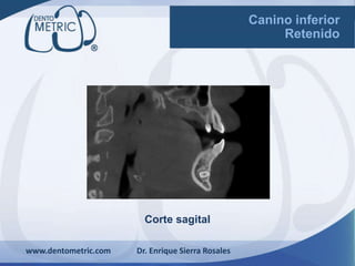 Canino inferior retenido | PPTX