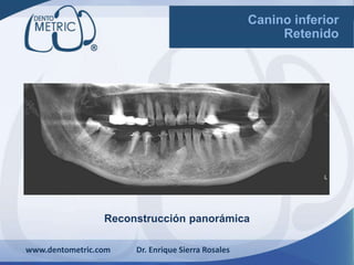 Canino inferior retenido | PPTX