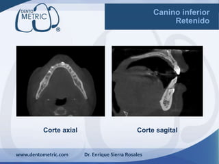 Canino inferior retenido | PPTX