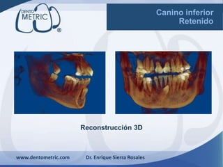 Canino inferior retenido | PPTX