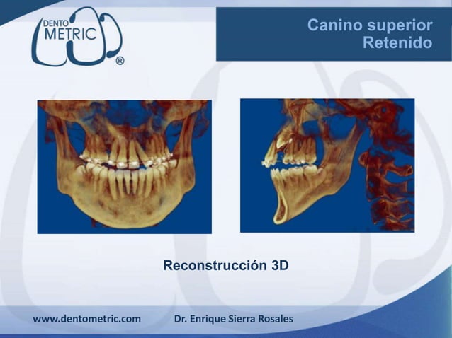 Canino retenido | PPTX | Dental Health | Diseases and Conditions