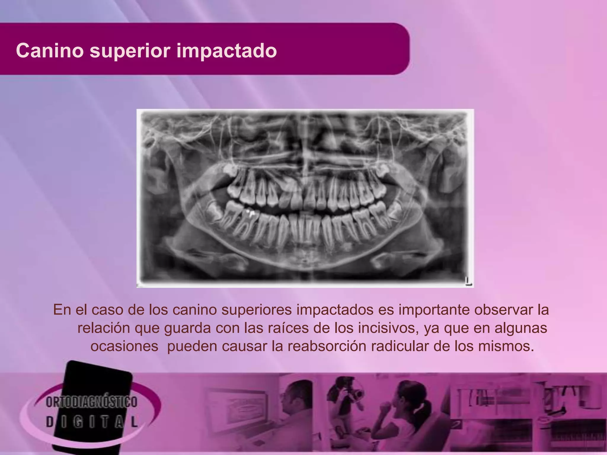 Canino superior impactado | PPTX