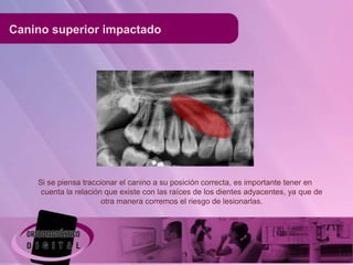 Canino superior impactado | PPTX