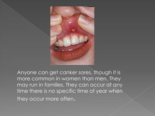 Canker sores | PPTX