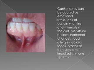 Canker sores | PPT