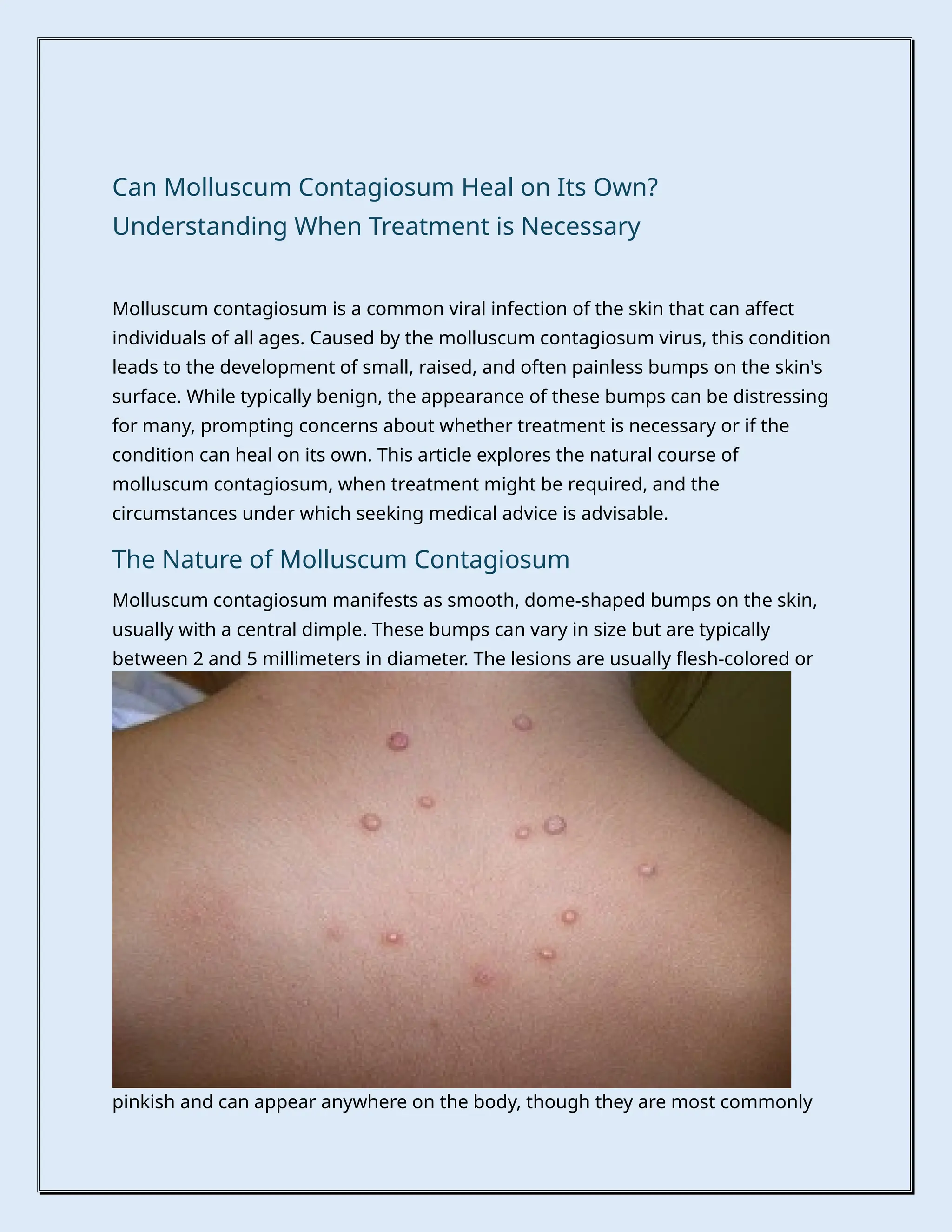 Can Molluscum Contagiosum Heal on Its Own? Understanding When Treatment is Necessary | DOCX