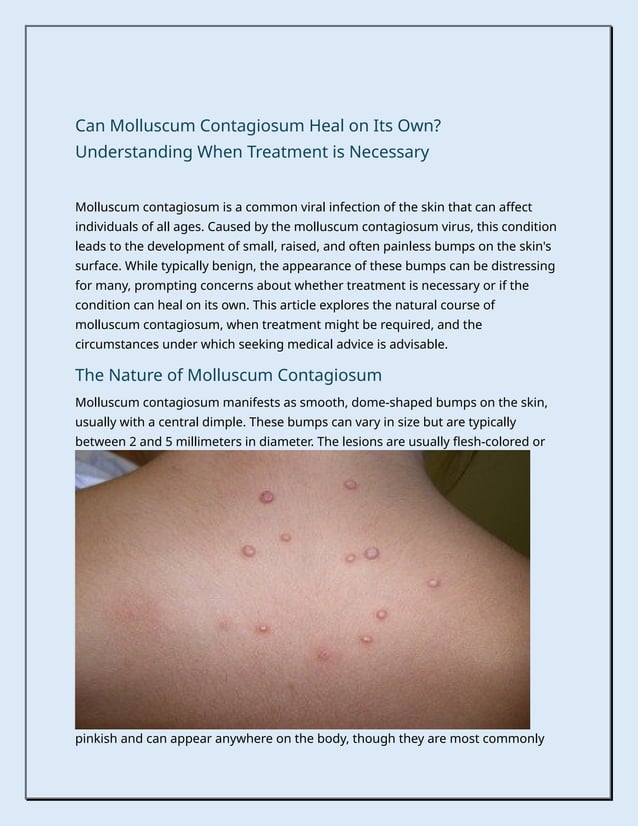 Can Molluscum Contagiosum Heal on Its Own? Understanding When Treatment ...