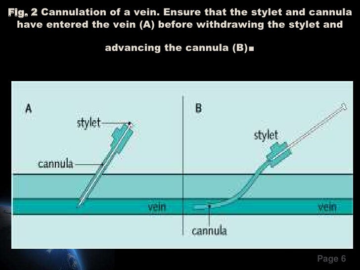 Peripheral Venous Cannulation