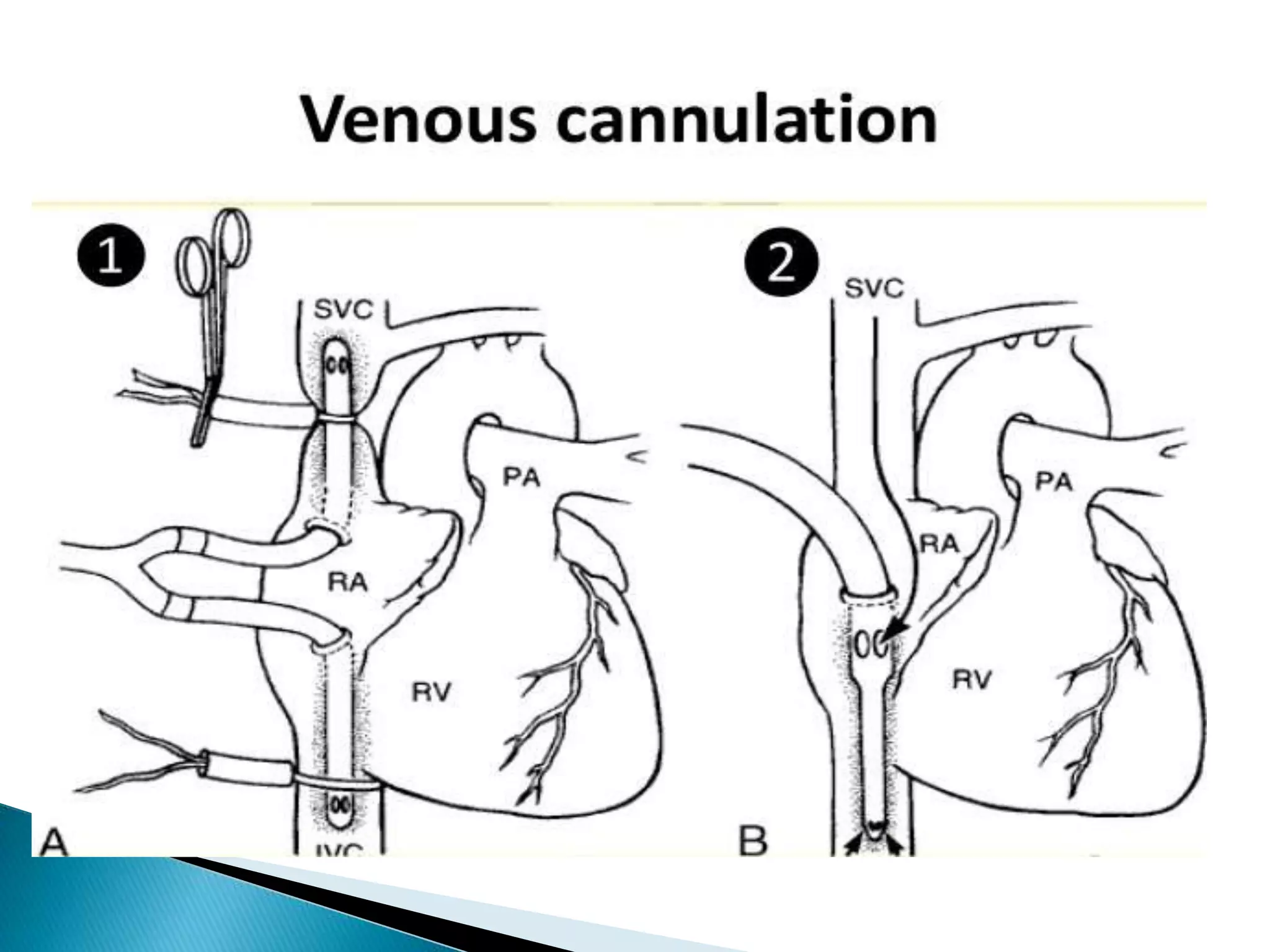 Cannulation and cardiopulmonary bypass. | PPTX