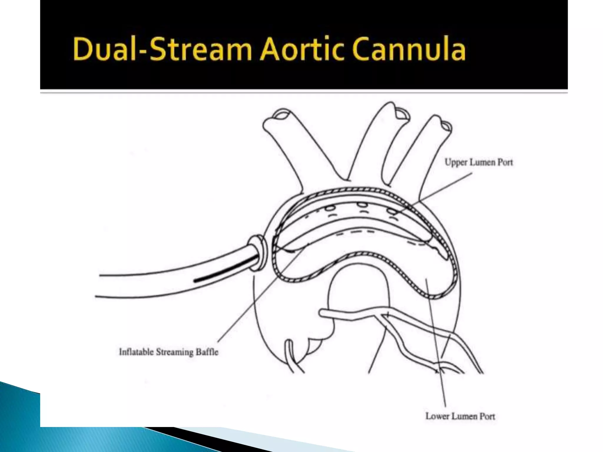 Cannulation and cardiopulmonary bypass. | PPTX