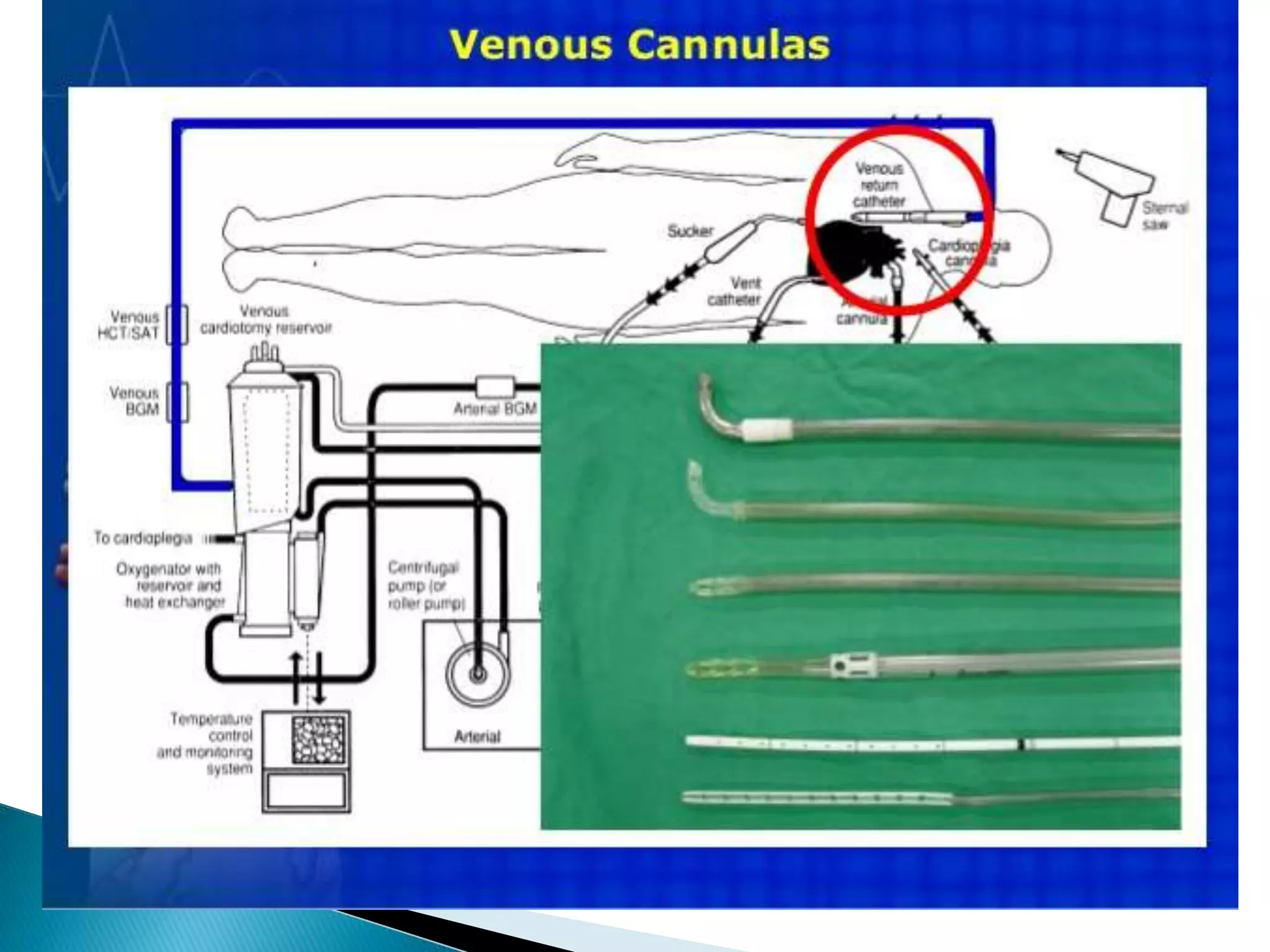 Cannulation and cardiopulmonary bypass. | PPTX