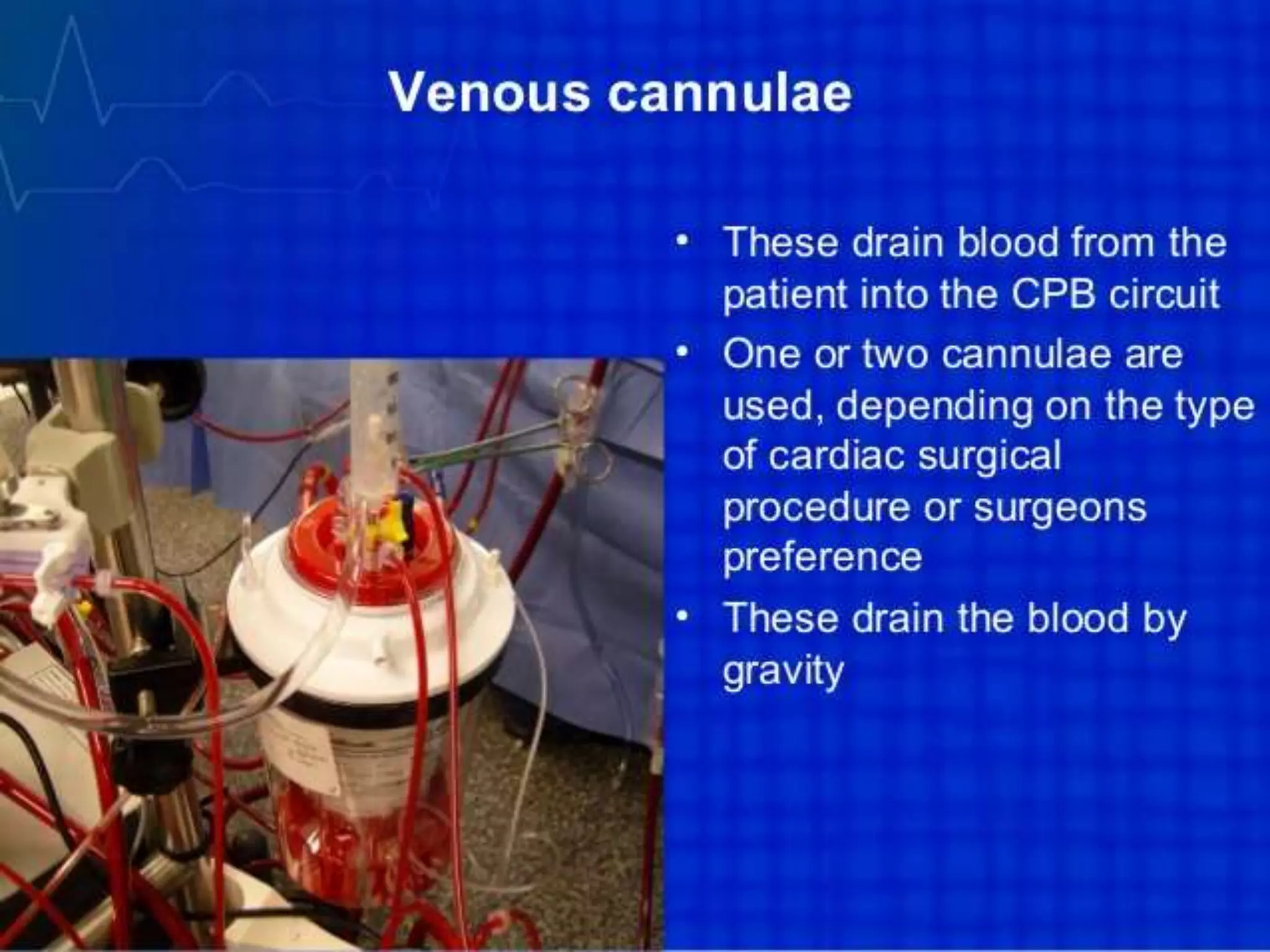 Cannulation and cardiopulmonary bypass. | PPTX