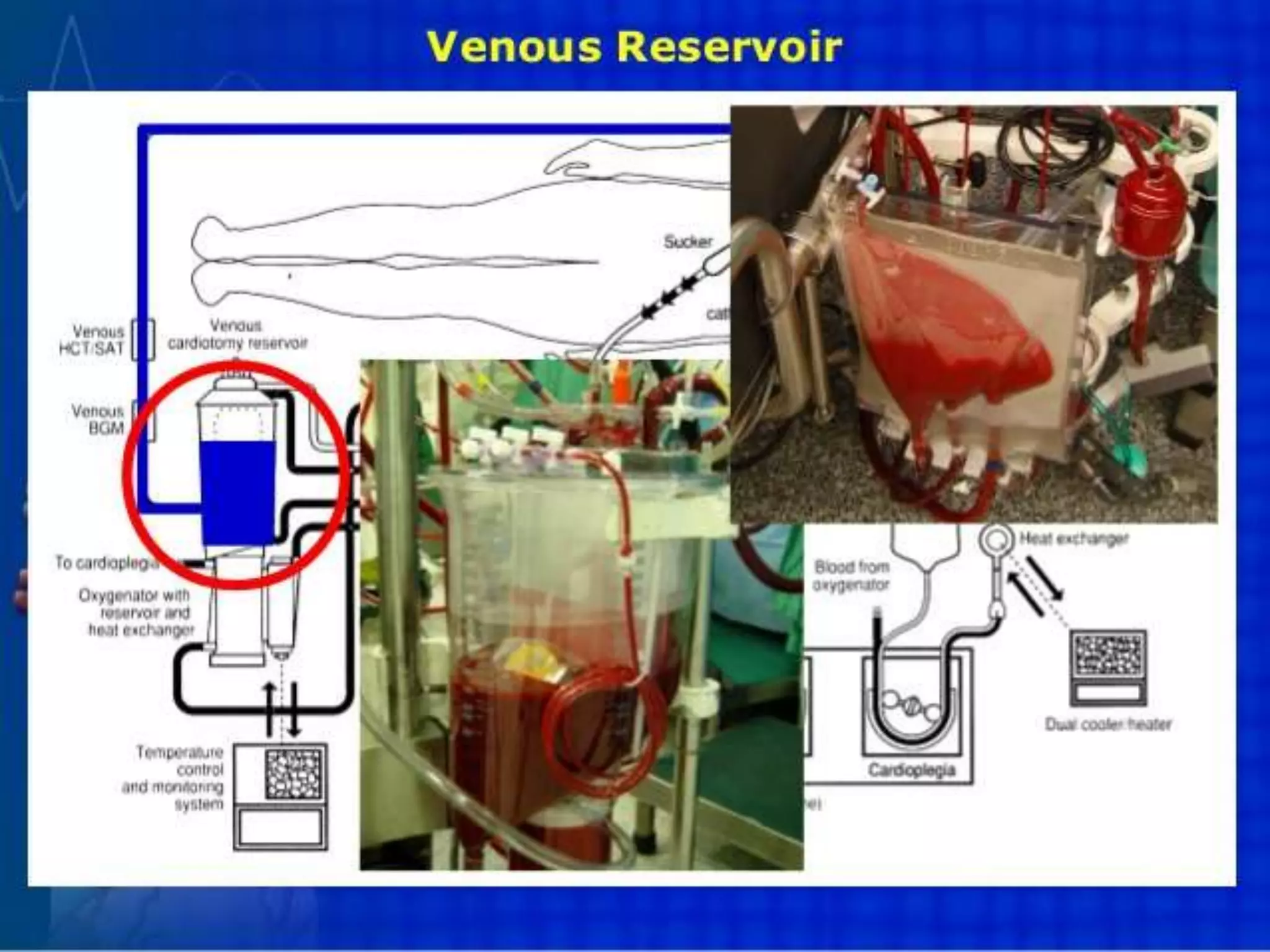 Cannulation and cardiopulmonary bypass. | PPTX