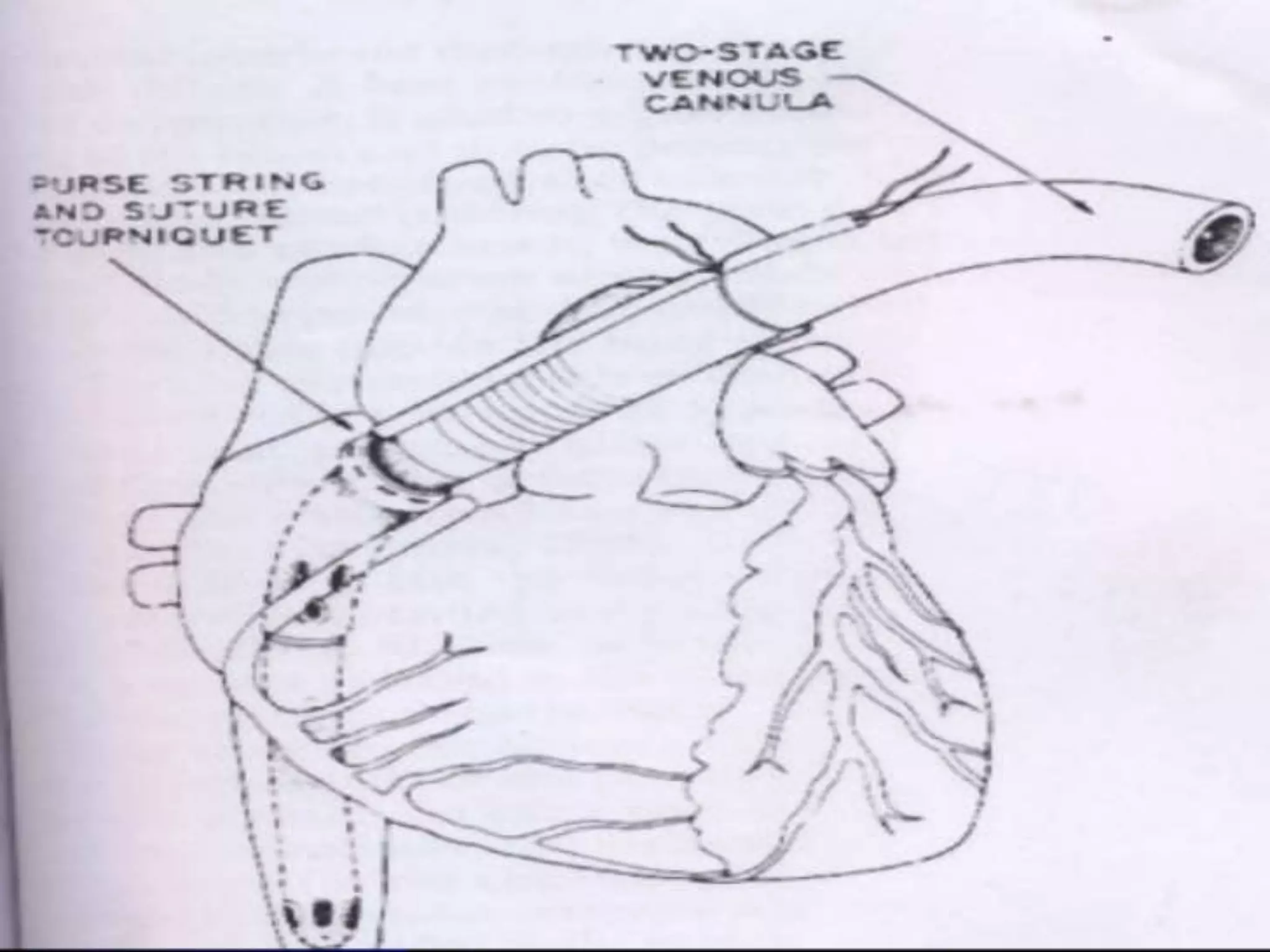 Cannulation and cardiopulmonary bypass. | PPTX