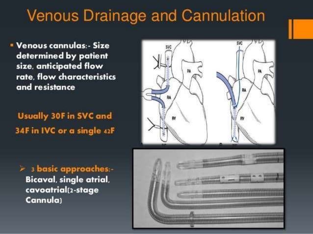 Cannulation and cardiopulmonary bypass. | PPTX