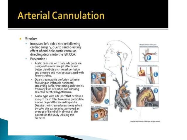 Cannulation and cardiopulmonary bypass. | PPTX