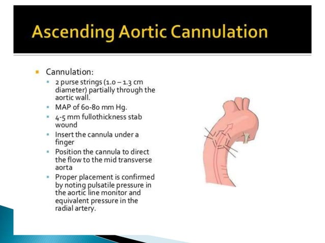 Cannulation and cardiopulmonary bypass. | PPTX