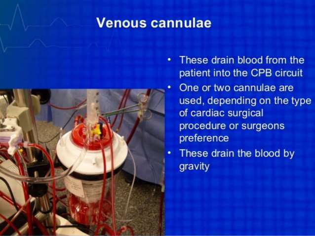 Cannulation and cardiopulmonary bypass. | PPTX