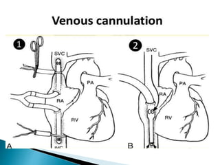 Cardiopulmonary Bypass Cannulation
