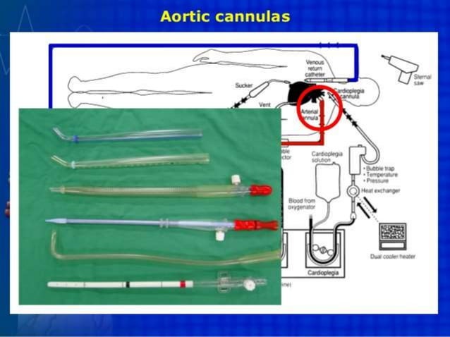 Cannulation and cardiopulmonary bypass.